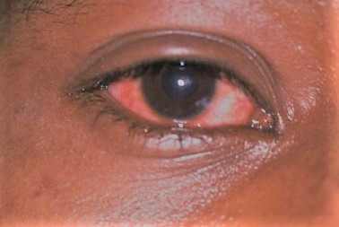 Mombasa County issues alert over outbreak of Red Eye - sauce.co.ke